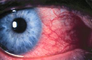 Automated Ocular Grading Interim Report